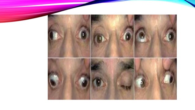 ESODEVIATION AND ITS APPROACH.pptx | Eye and Vision Conditions ...