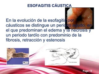 Esofagitis | PPT