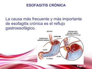 Esofagitis | PPT