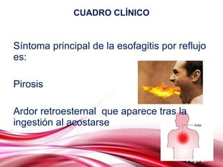 Esofagitis | PPT