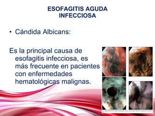 Esofagitis | PPT