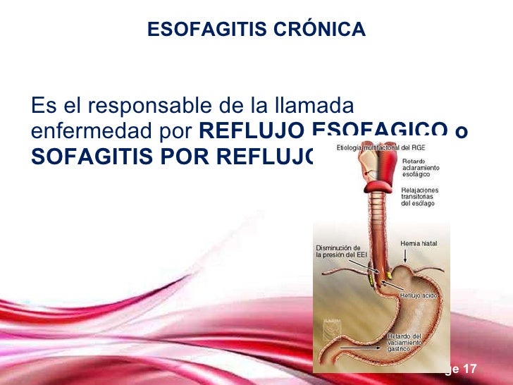 ¿Cuál Es La Gravedad De La Esofagitis De Grado A? – PING