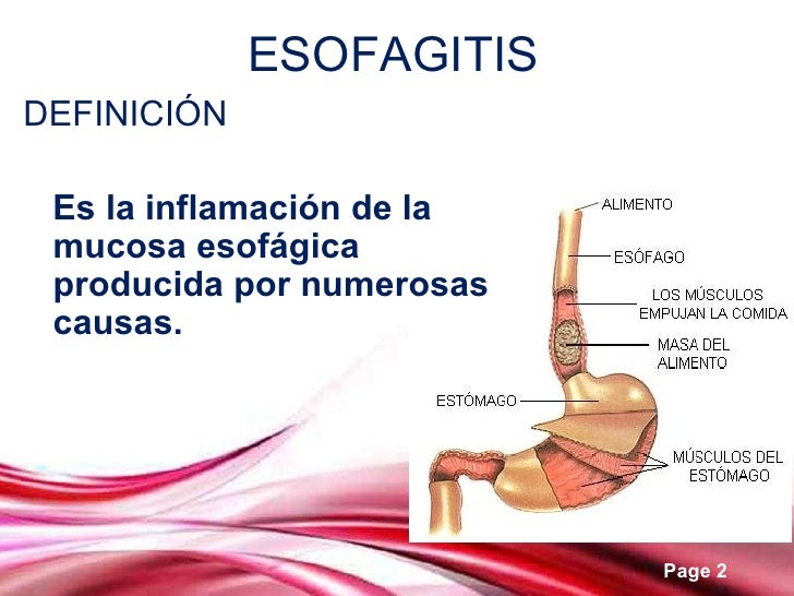 Esofagitis