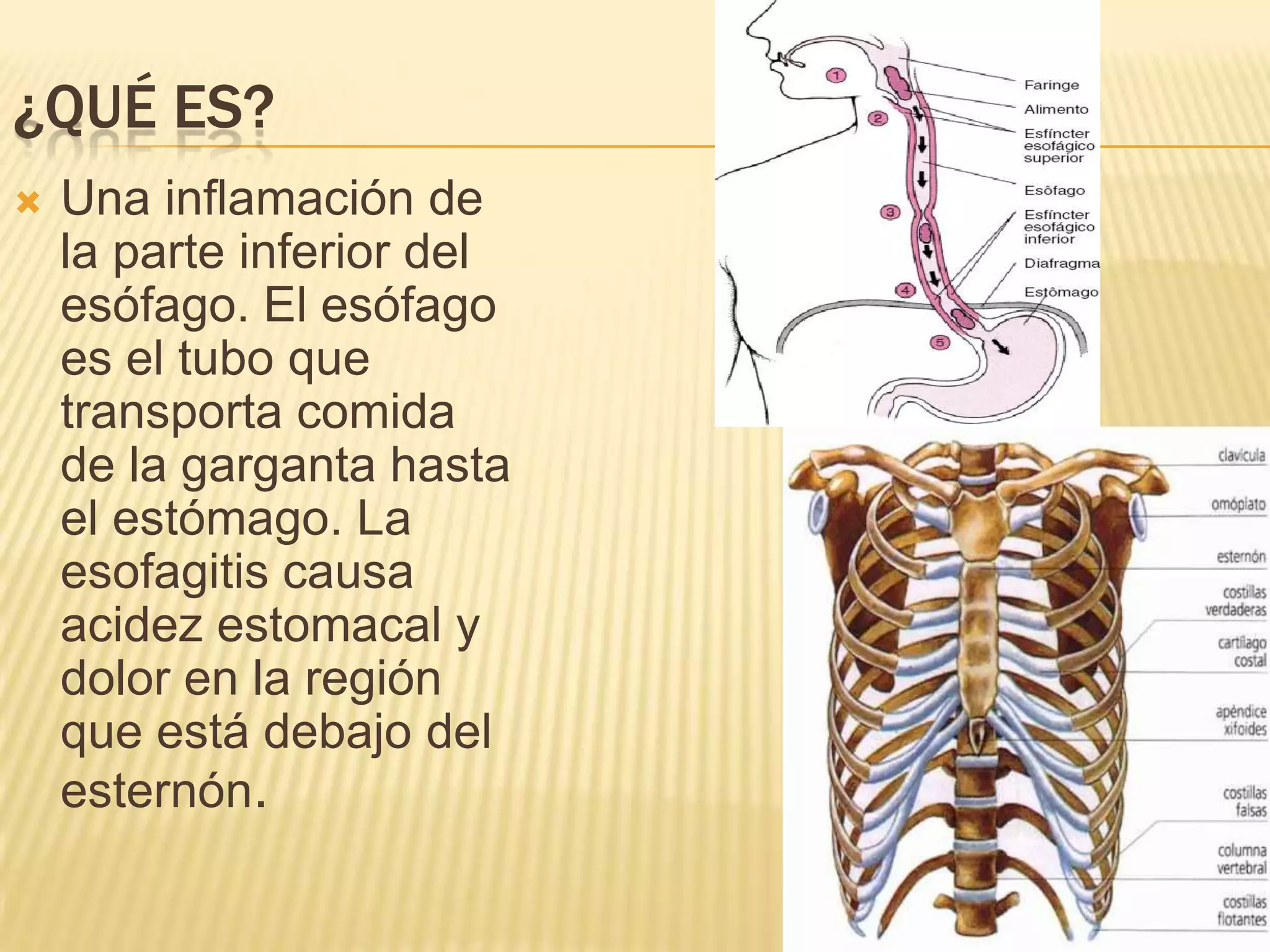 Esofagitis | PPTX