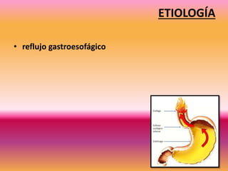 Esofagitis | PPTX