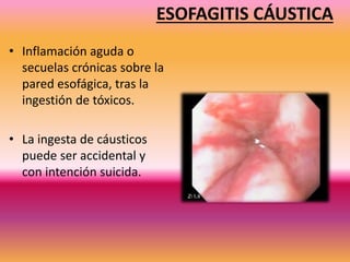 Esofagitis | PPTX