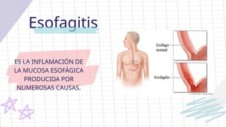 EXPOSICION PRESENTACION DE ESOFAGITIS.pptx