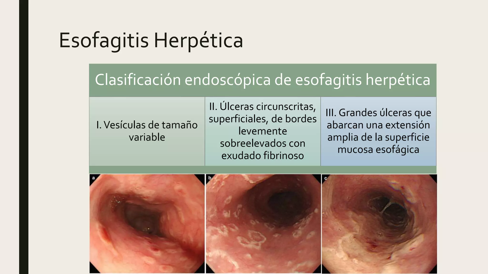 Esofagitis clasif angeles- esof barret | PPTX | Infectious Diseases ...