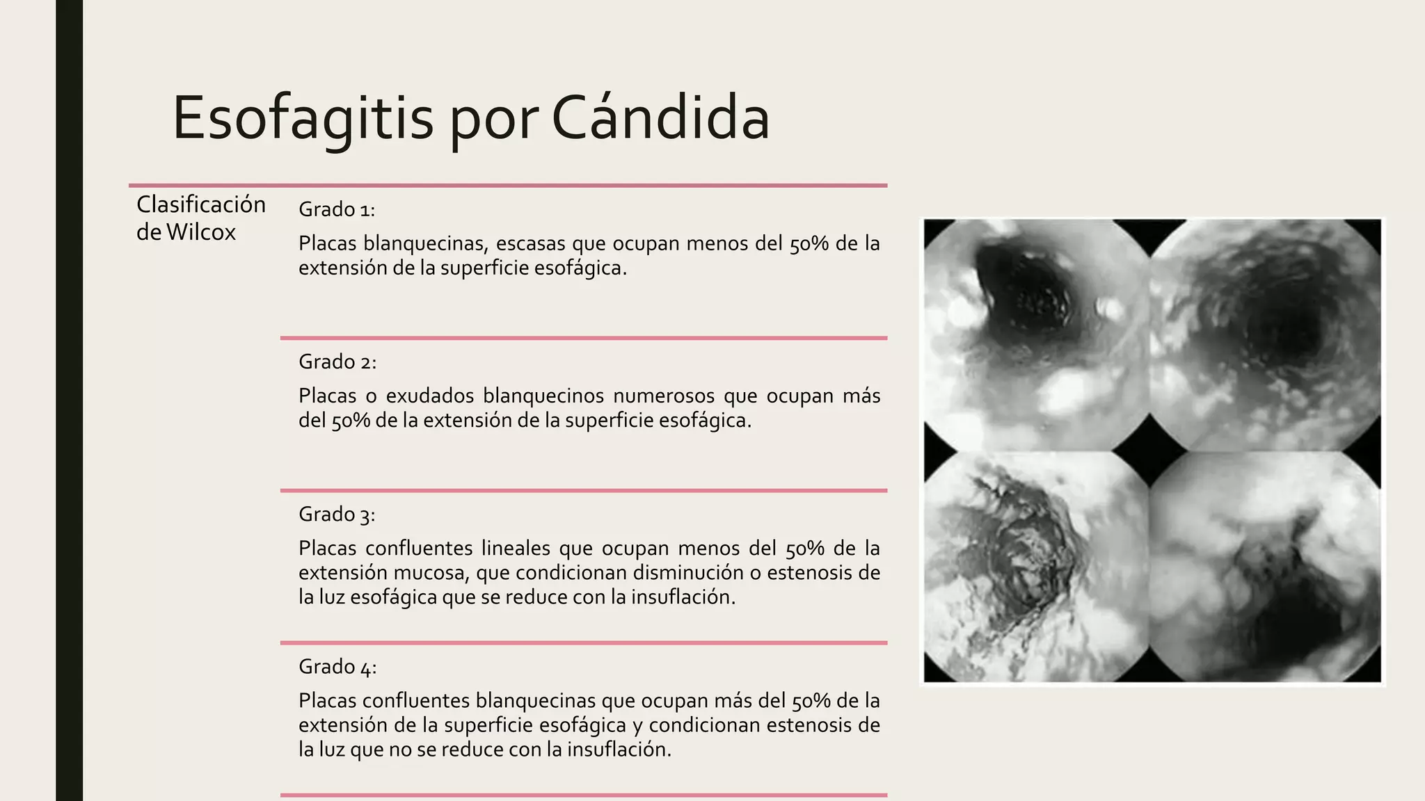 Esofagitis clasif angeles- esof barret | PPTX | Infectious Diseases ...