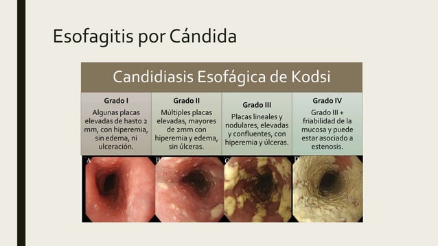 Esofagitis clasif angeles- esof barret