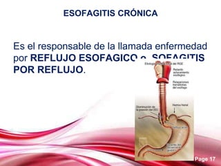 Tema esofagitis tema para exponer en clase | PPT