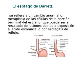 Esofagitis barret acalacia | PPT