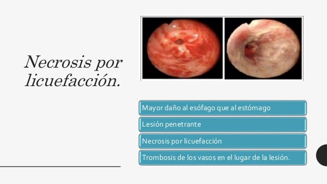 Esofagitis caustica