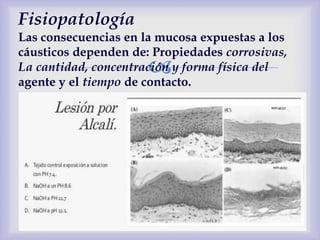 ESOFAGITIS CAUSTICA | PPTX