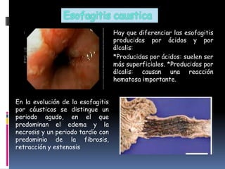 Esofagitis diapos | PPTX