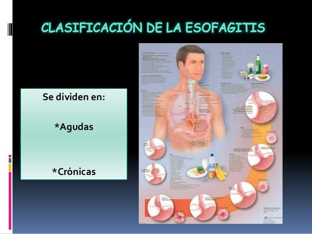 Causas De La Esofagitis _ CAUSAS DE LA ESOFAGITIS, DIAGNOSTICO Y ...