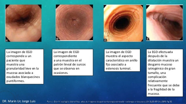 Esofagitis eosinofílica