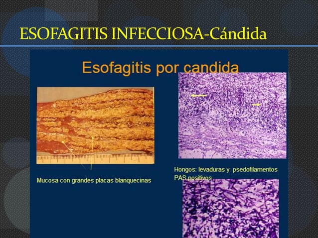 Esofagitis infecciosa y gastritis aguda | PPTX | Digestive Disorders ...