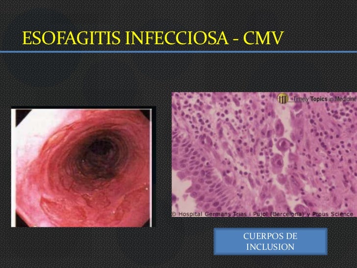 Esofagitis infecciosa y gastritis aguda