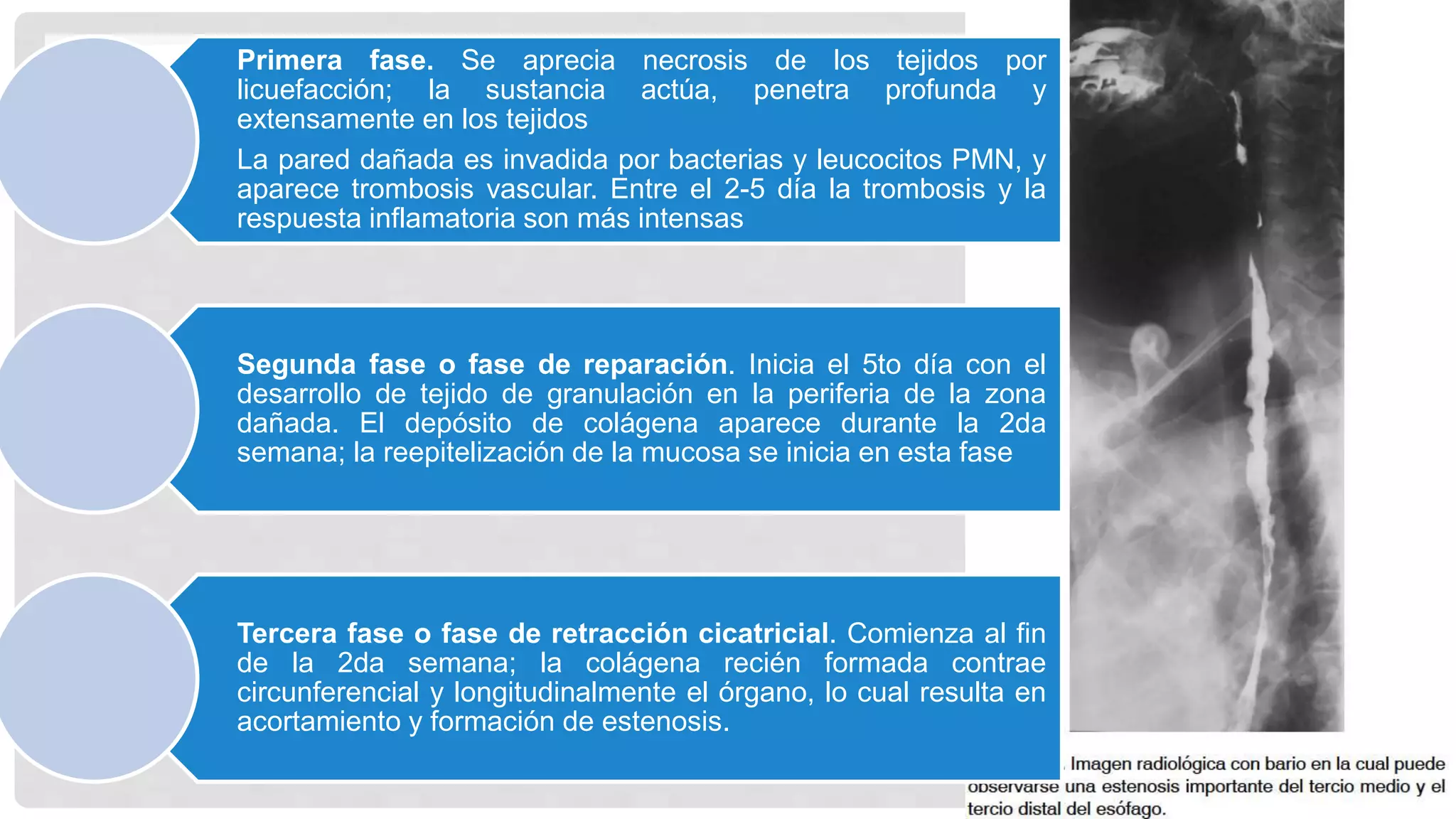 Esofagitis por cáusticos | PPTX