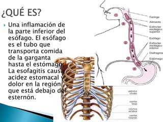 Esofagitis por reflujo | PPTX