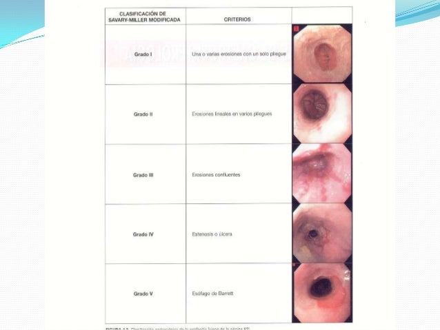 Esofagitis por reflujo