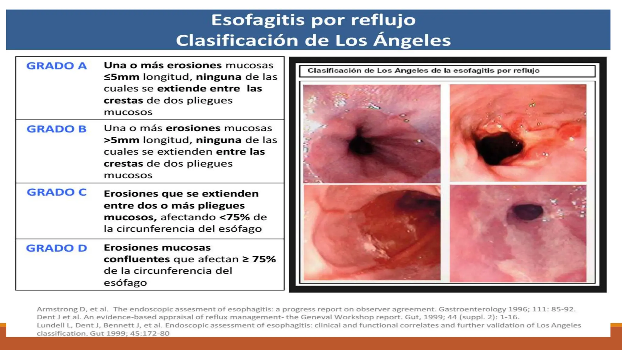 ESOFAGITIS POR REFLUJO GASTROESOFAGICO, ESOFAGITIS POSCAUSTICO Y.pptx