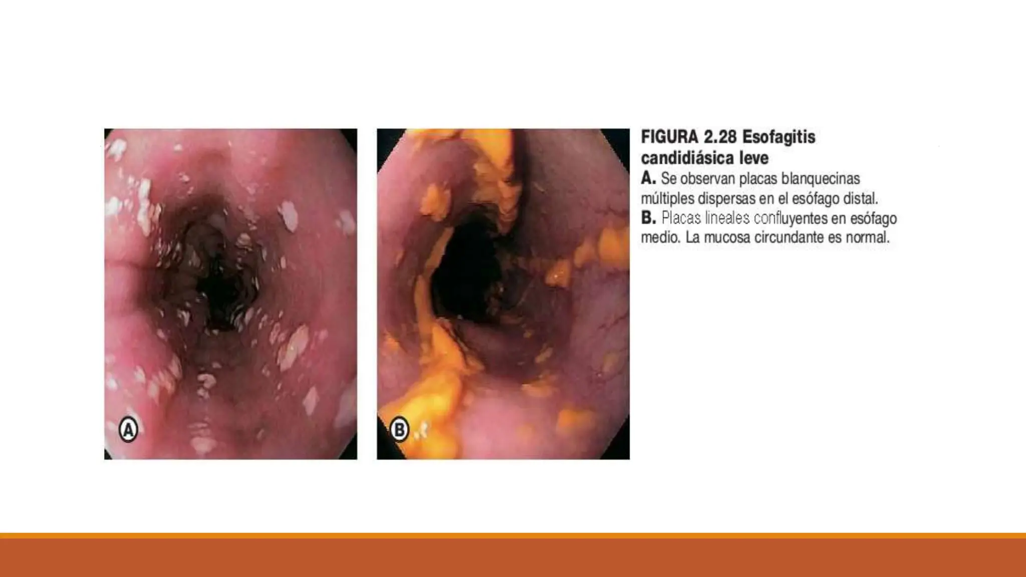 ESOFAGITIS POR REFLUJO GASTROESOFAGICO, ESOFAGITIS POSCAUSTICO Y.pptx