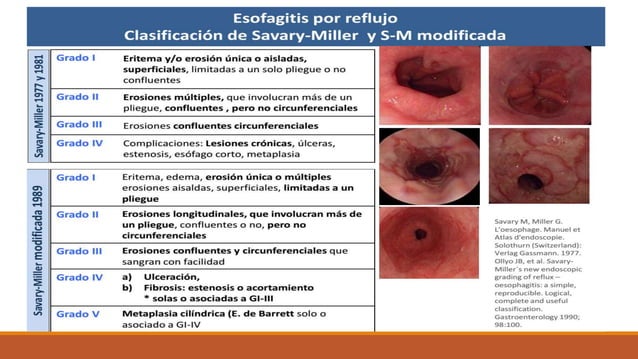 ESOFAGITIS POR REFLUJO GASTROESOFAGICO, ESOFAGITIS POSCAUSTICO Y.pptx
