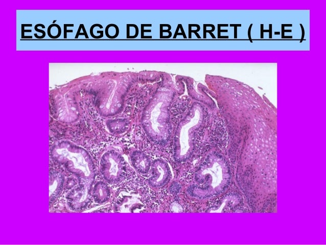 Esofagitis por reflujo y esofago de barrett.