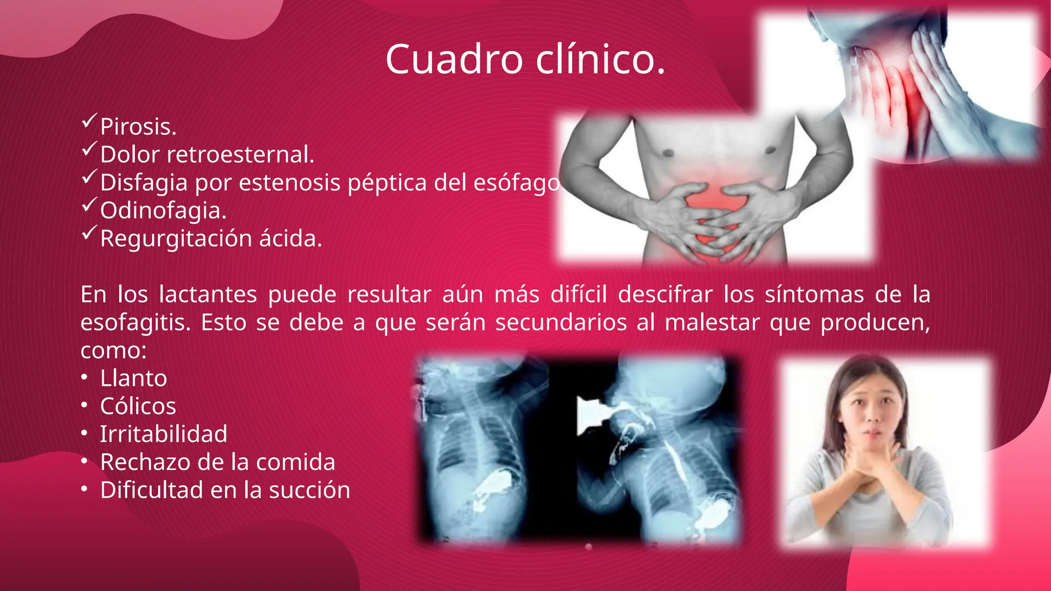 Esofagitis péptica Y ERGE y otros tipos.pptx
