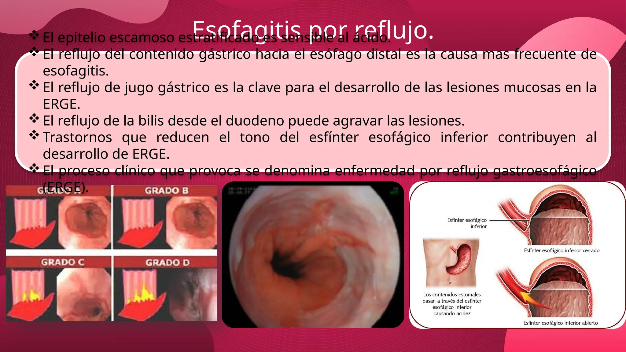 Esofagitis péptica Y ERGE y otros tipos.pptx