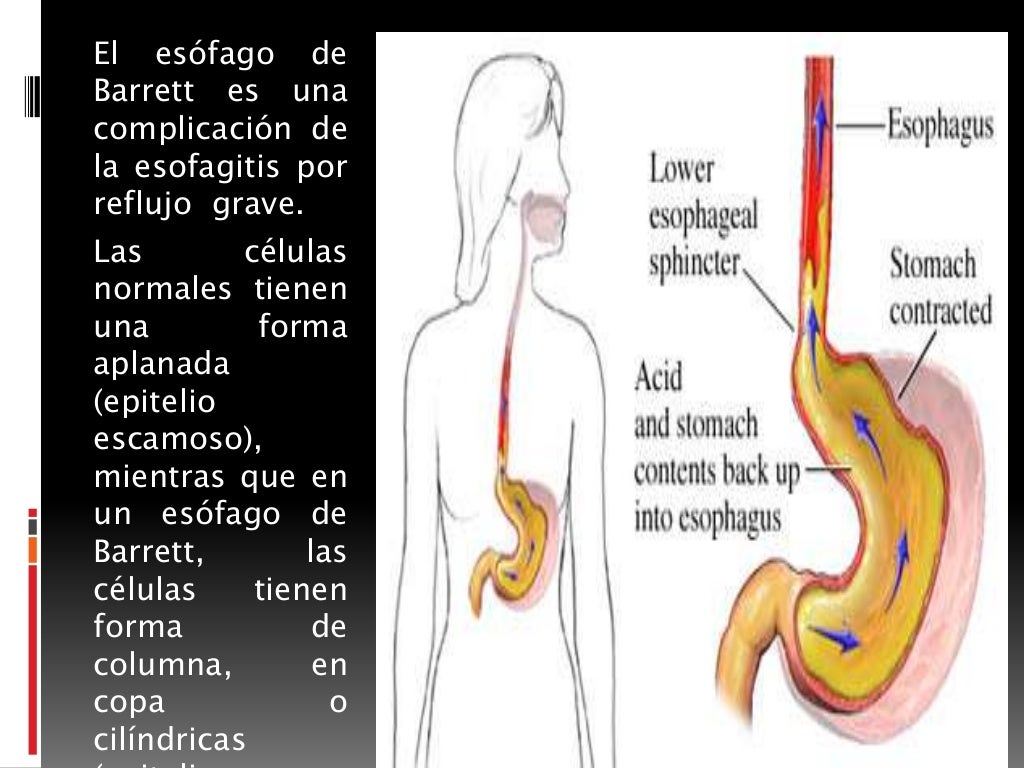 Esofago Que Es El Esofago Funcion E Importancia Images