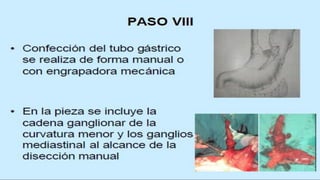 CIRUGIA DE ESOFAGO (ESOFAGECTOMIA) Y ANATOMIA | PDF