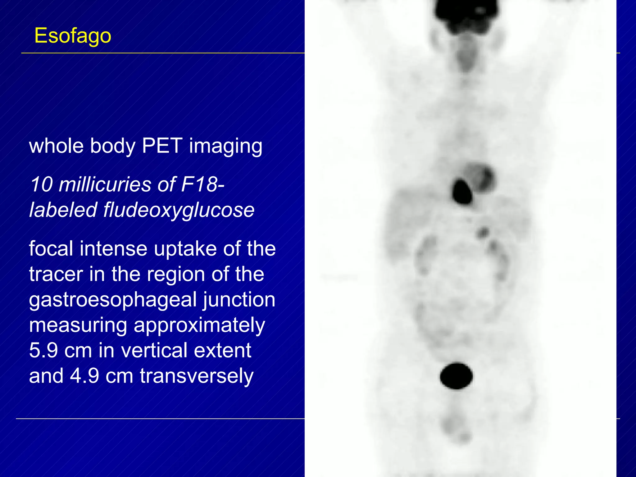 Esofago Carcinoma | PPT