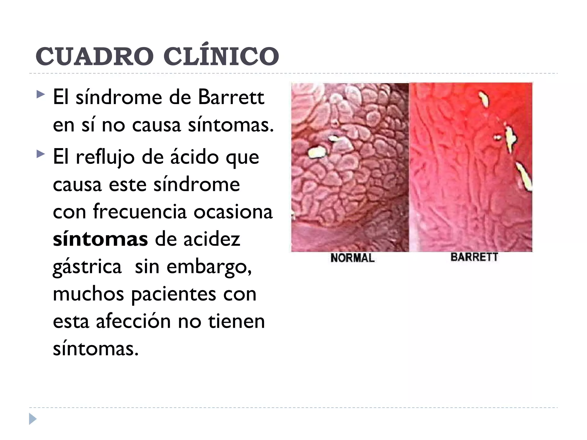 Esofago de-barret | PPT