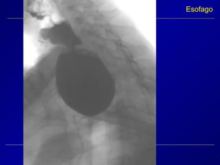 Esofago Diverticoli | PPT