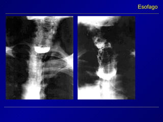 Esofago Diverticoli | PPT