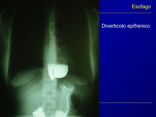 Esofago Diverticoli | PPT