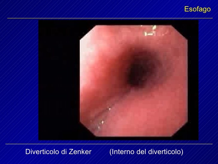 Esofago Diverticoli