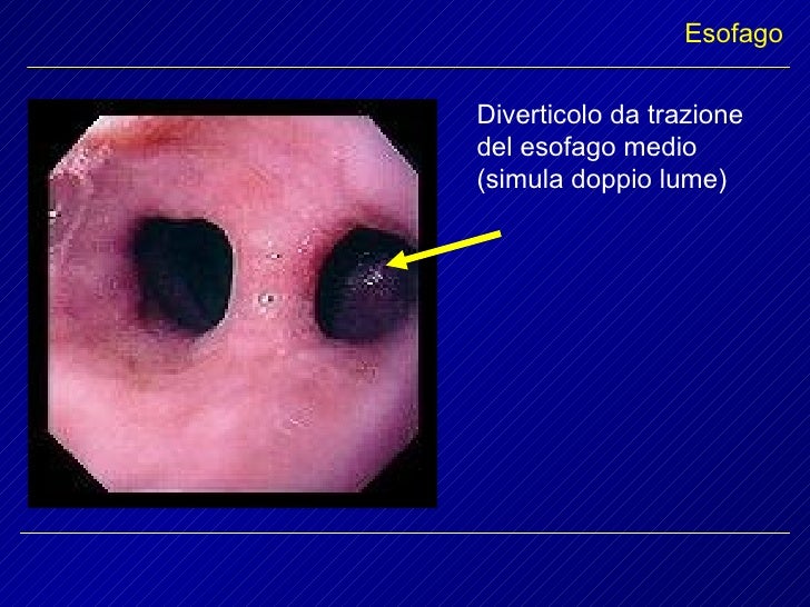 Esofago Diverticoli