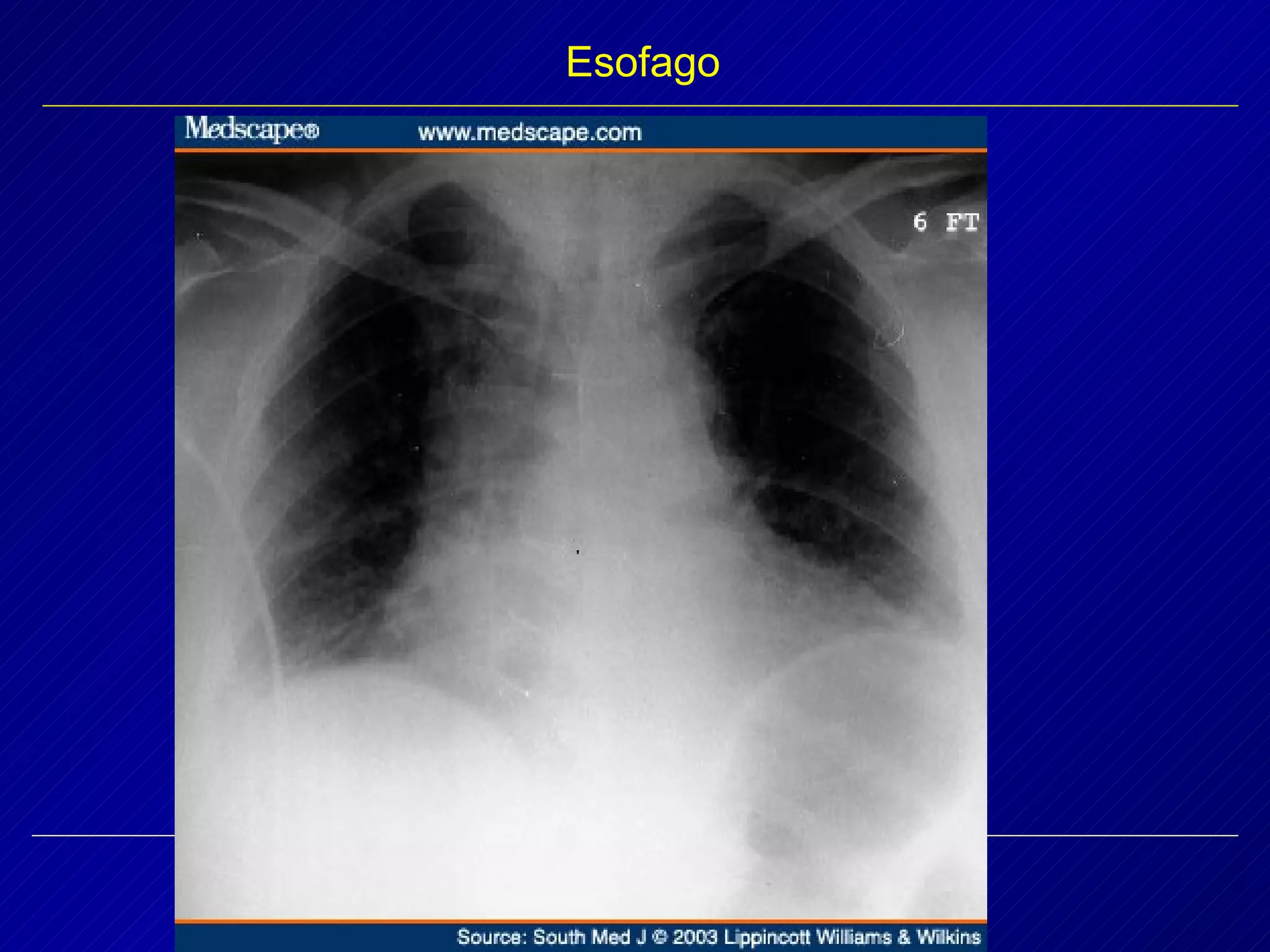 Esofago Perforazioni | PPT