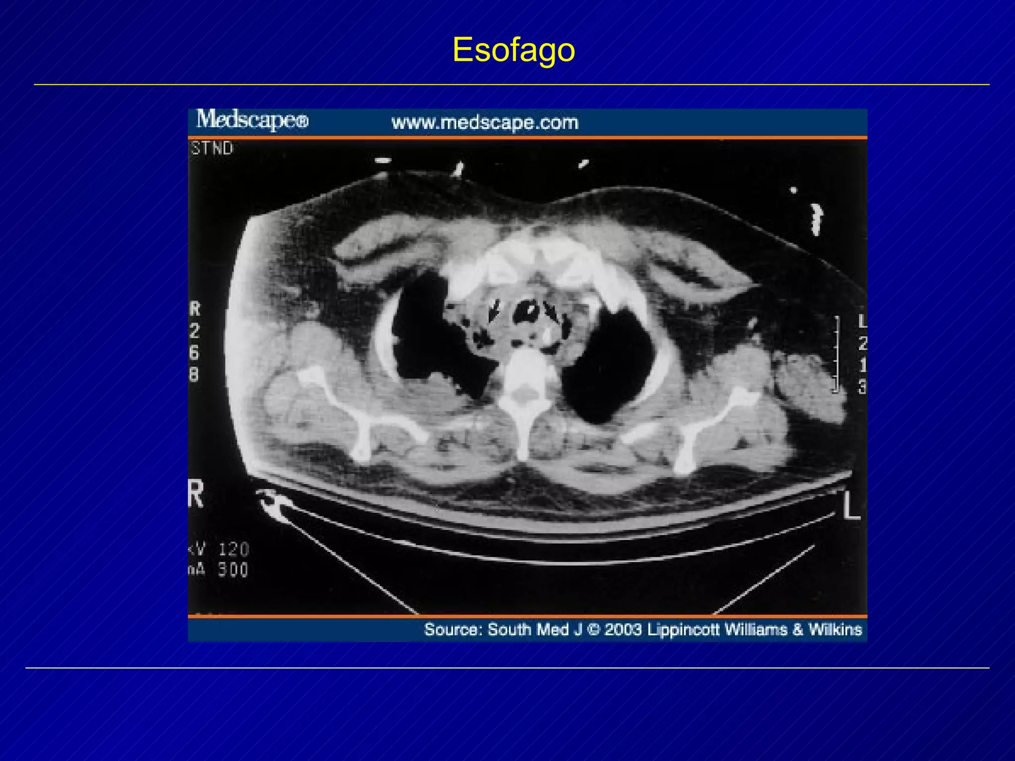 Esofago Perforazioni | PPT