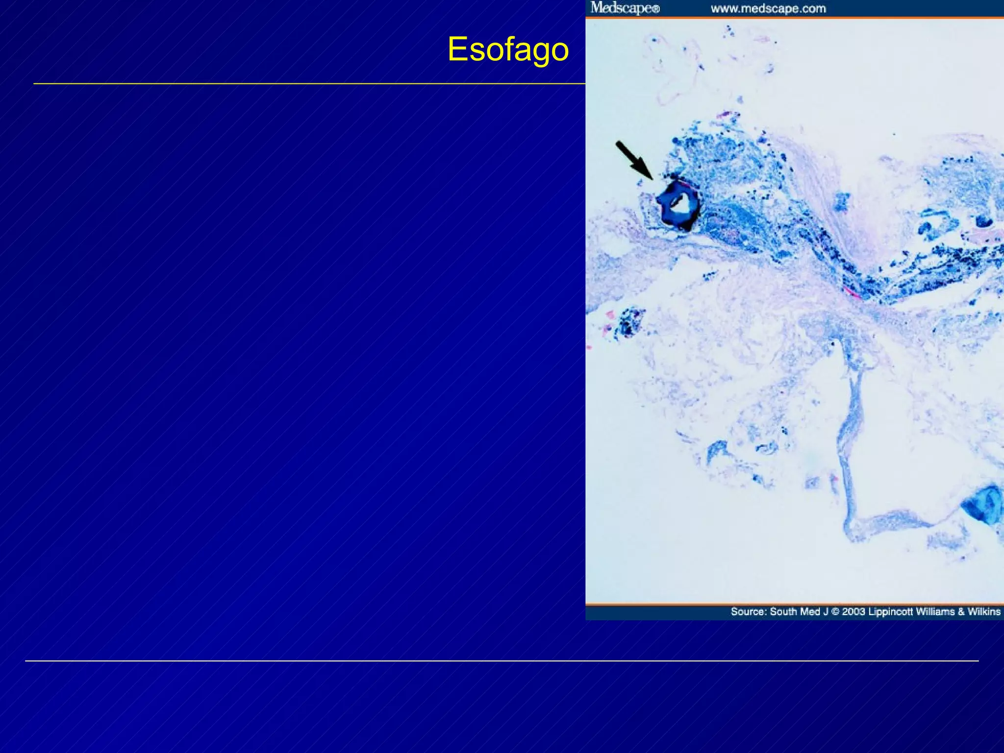 Esofago Perforazioni | PPT