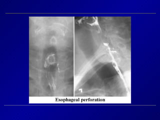 Esofago Perforazioni | PPT