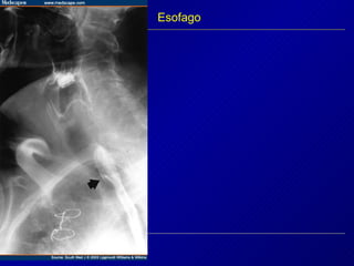 Esofago Perforazioni | PPT