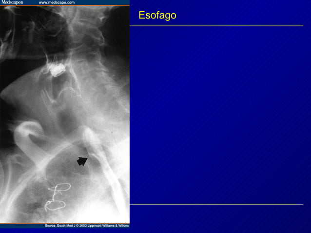 Esofago Perforazioni | PPT