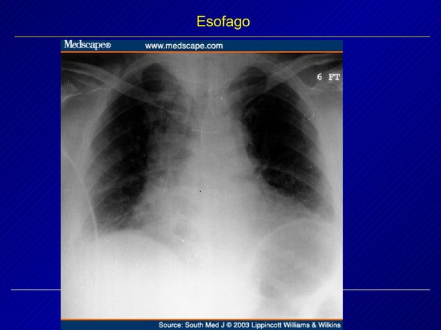 Esofago Perforazioni | PPT