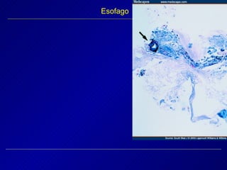 Esofago Perforazioni | PPT