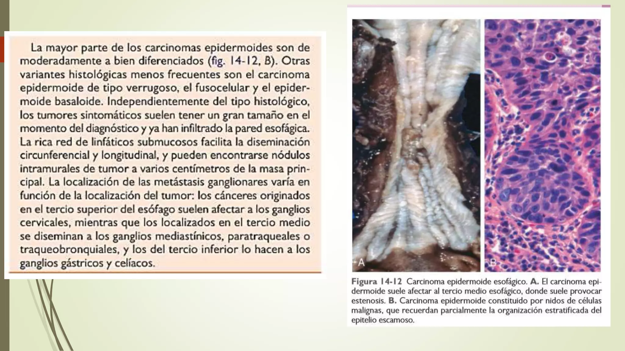Esofago anatomia patologica de Robbins capitulo 14 | PPTX